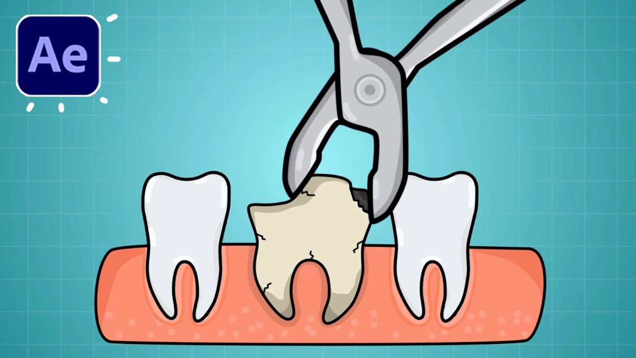 Tooth Extraction Medical Animation in After Effects Tutorials – CG ...